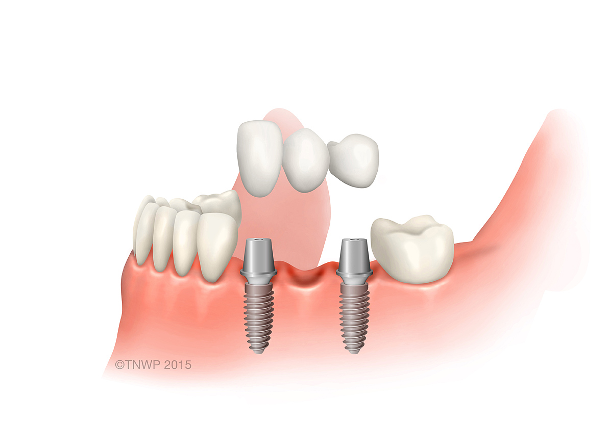 History of dental implants | treatment for missing teeth | tooth root ...