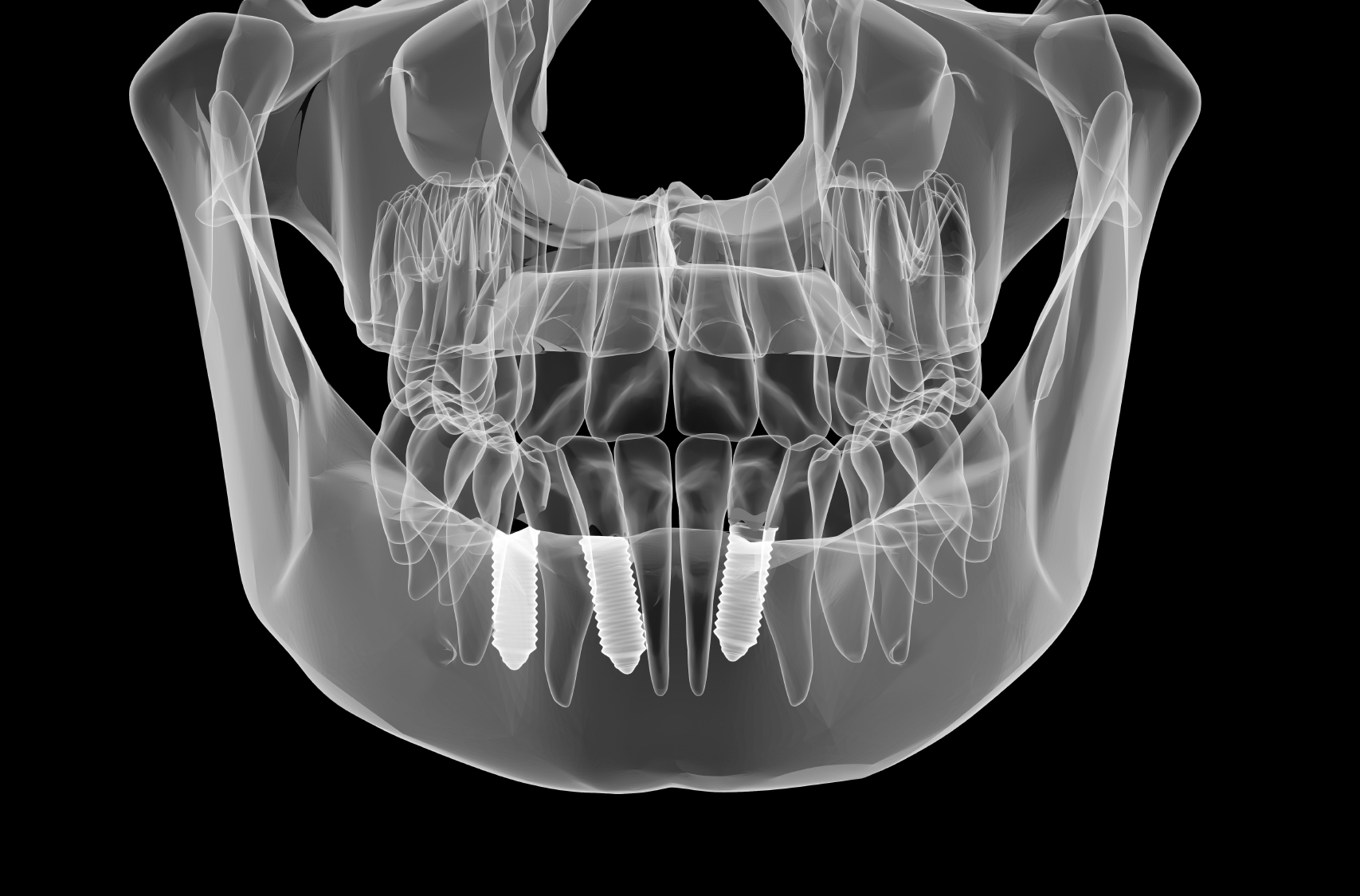 Dental Implants Xray